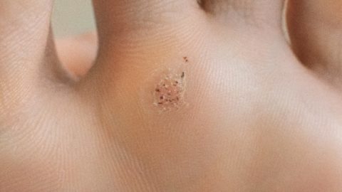Plantar Warts - Bloomington, IL - Heartland Foot & Ankle